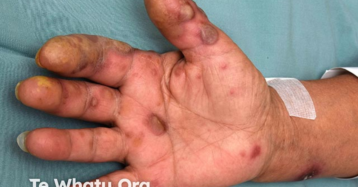 Acute febrile neutrophilic dermatosis image