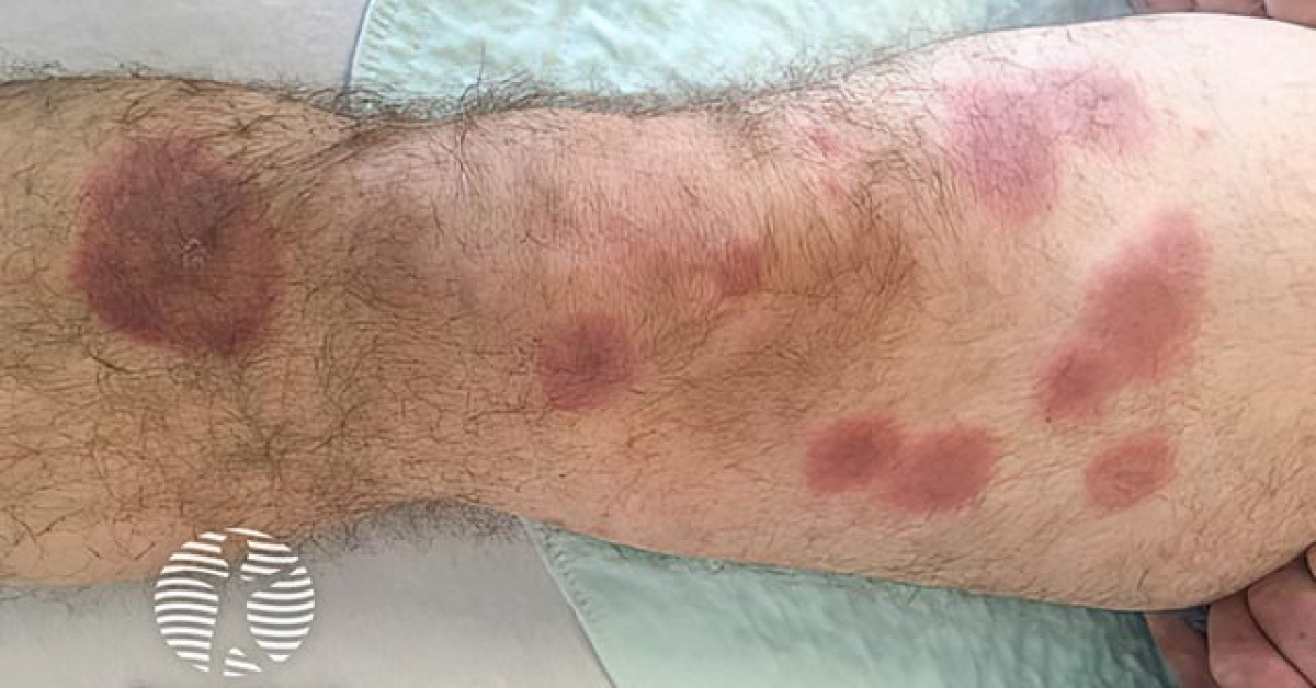 Acute febrile neutrophilic dermatosis image