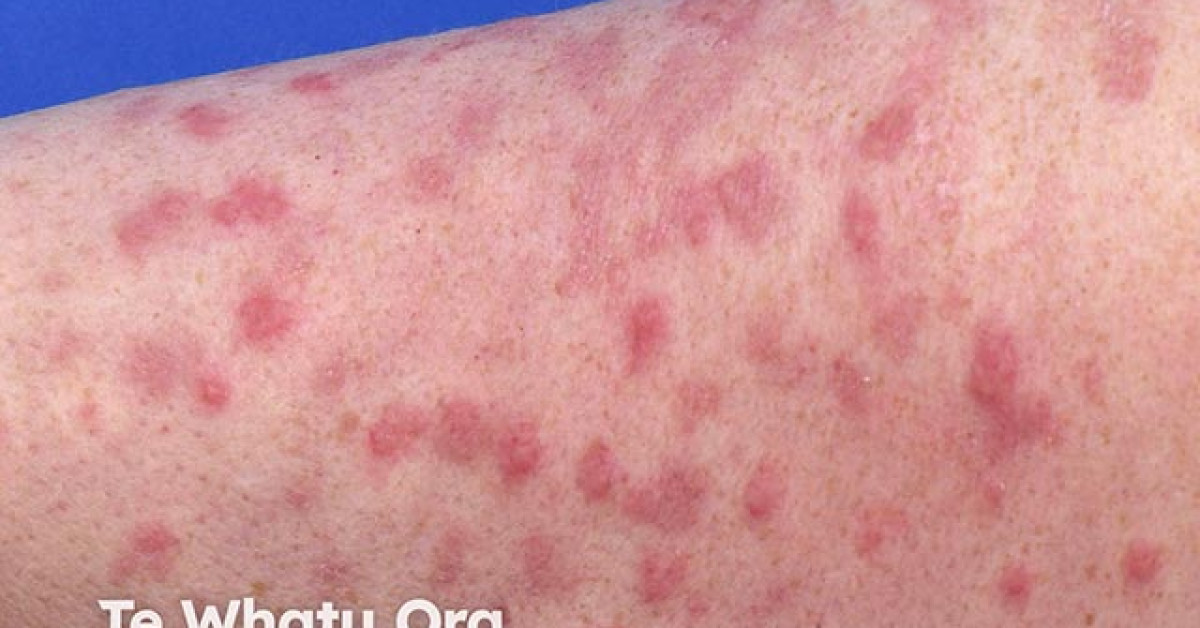 Acute febrile neutrophilic dermatosis image