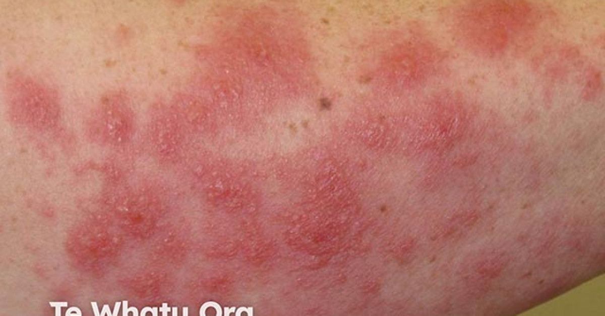 Acute febrile neutrophilic dermatosis image