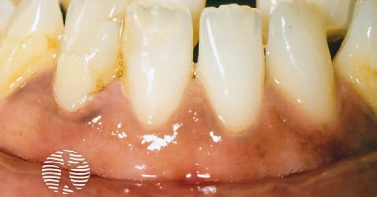 Addison's disease image