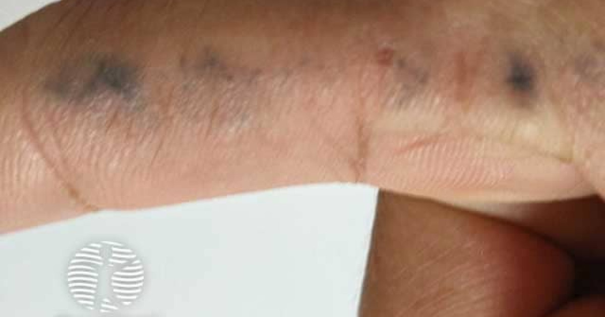 Alkaptonuria image