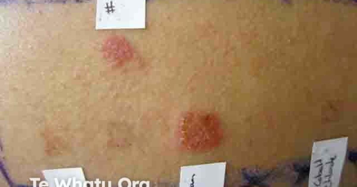 Allergic contact dermatitis image