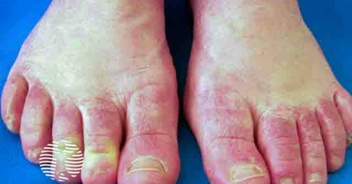 Allergic contact dermatitis image