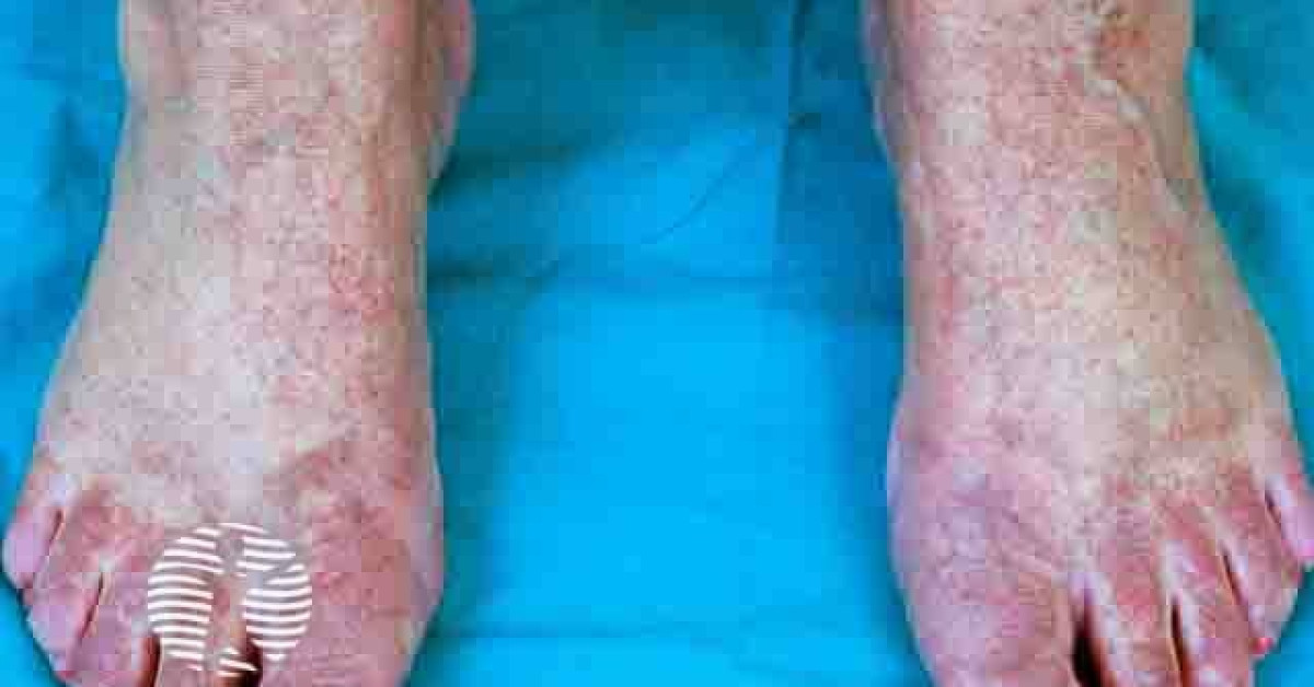 Allergic contact dermatitis image