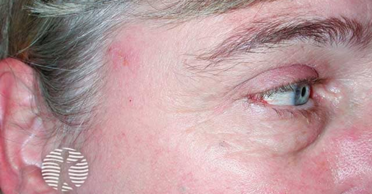 Allergic contact dermatitis image