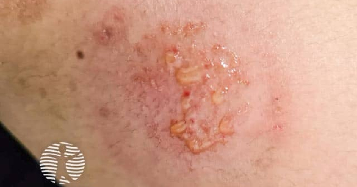 Allergic contact dermatitis image