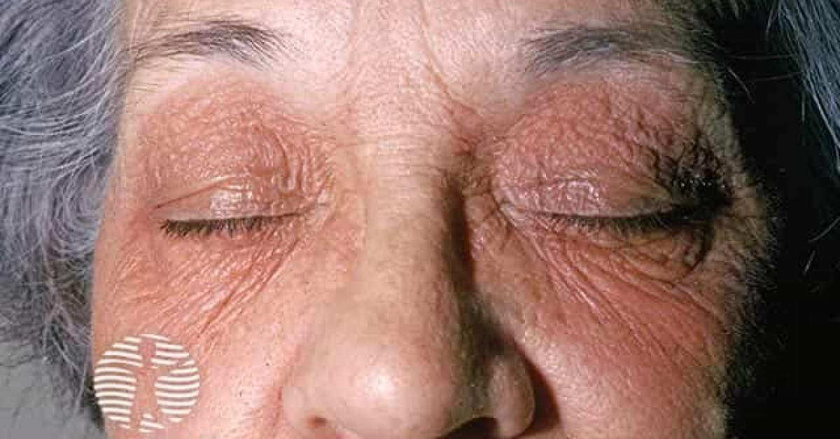 Allergic contact dermatitis image