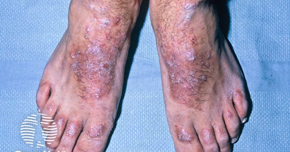 Allergic contact dermatitis image