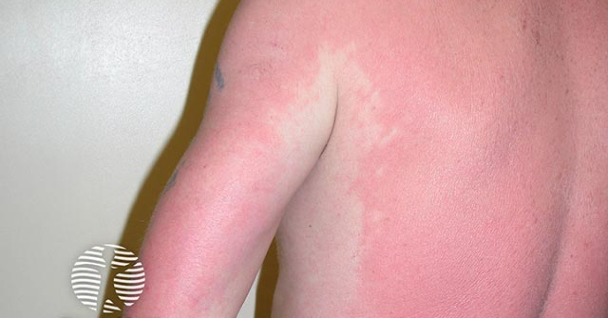 Allergic contact dermatitis image