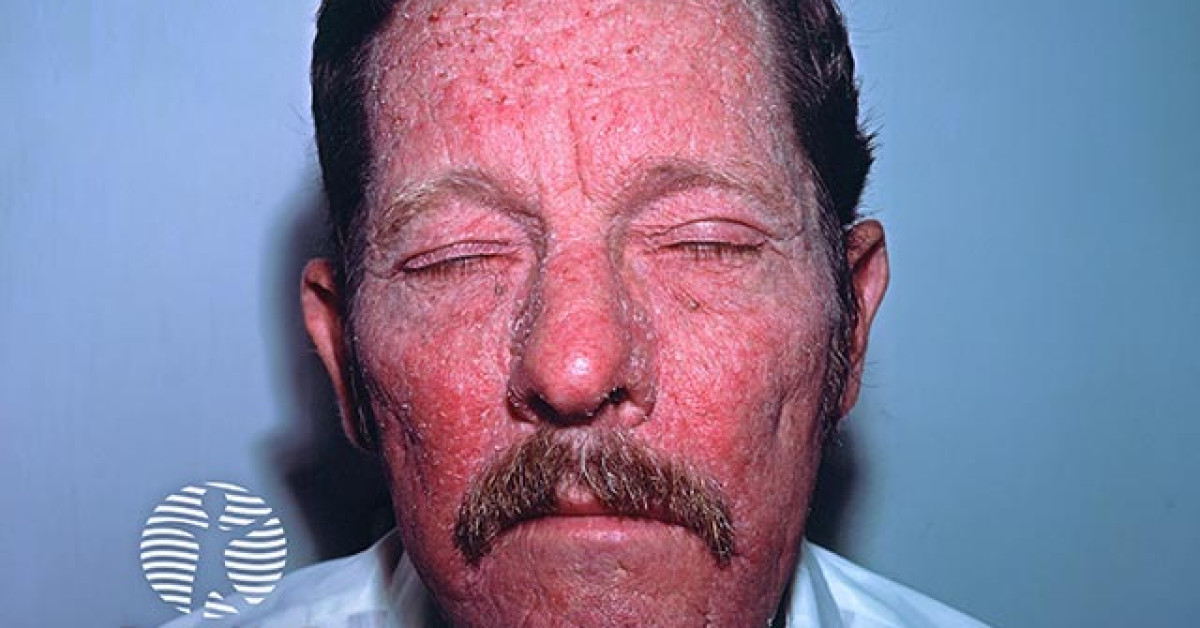 Allergic contact dermatitis image