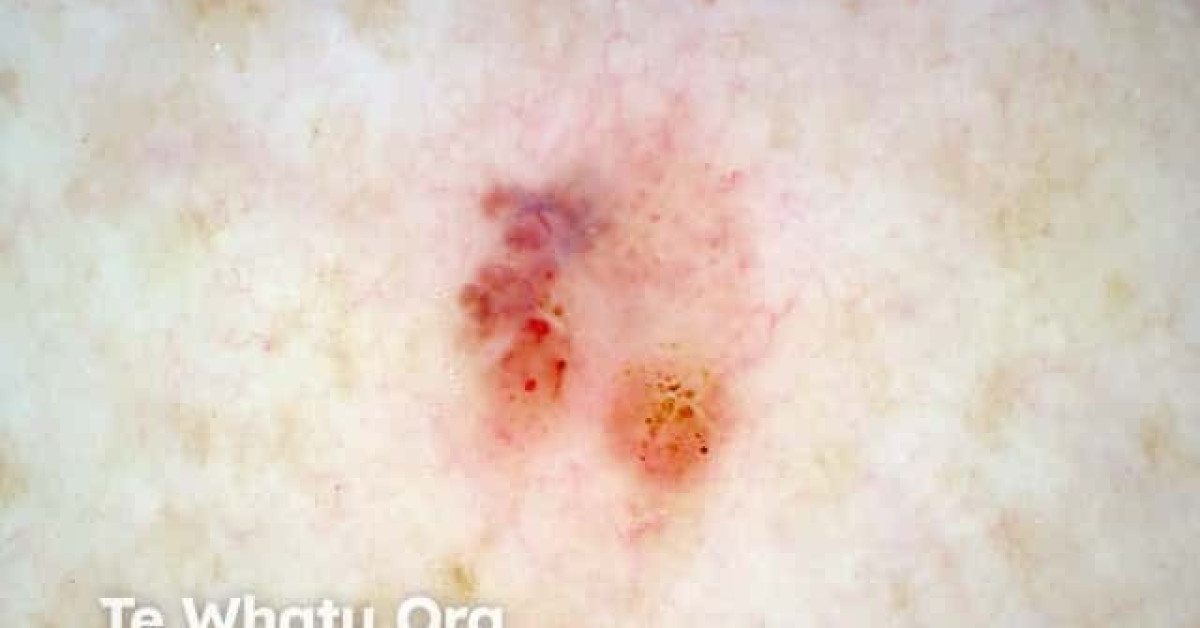 Amelanotic melanoma image