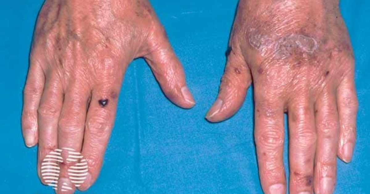 Amyloidosis image