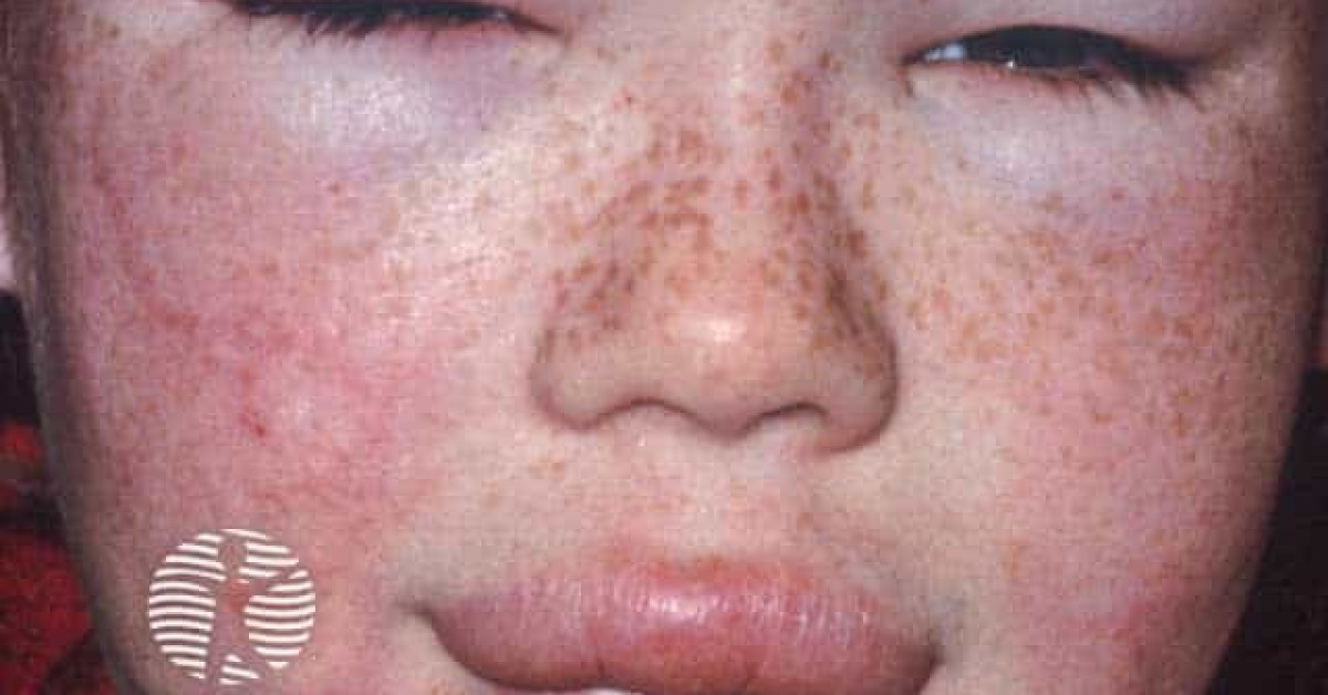 Angioedema image