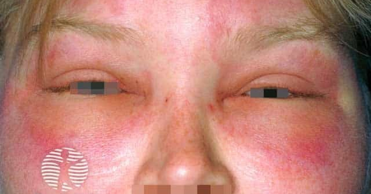 Angioedema image