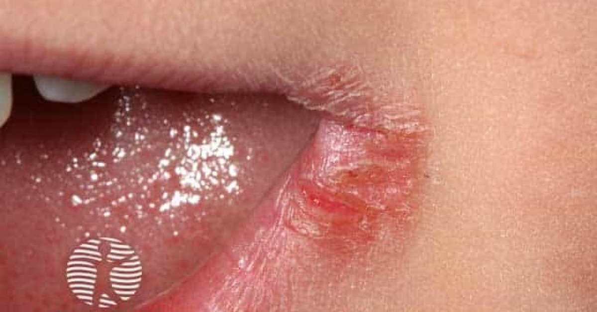 Angular Cheilitis Image 7371