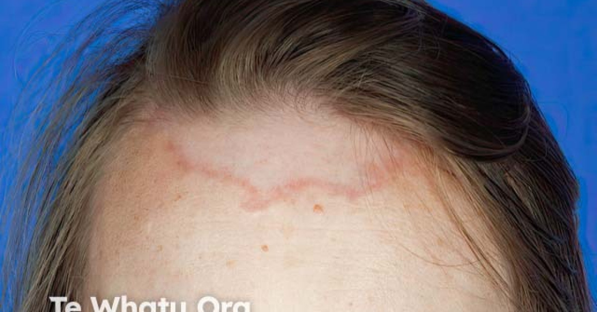 Annular elastolytic giant cell granuloma image