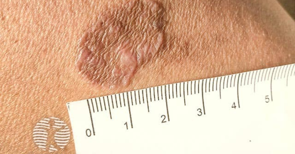 Annular lichen planus image