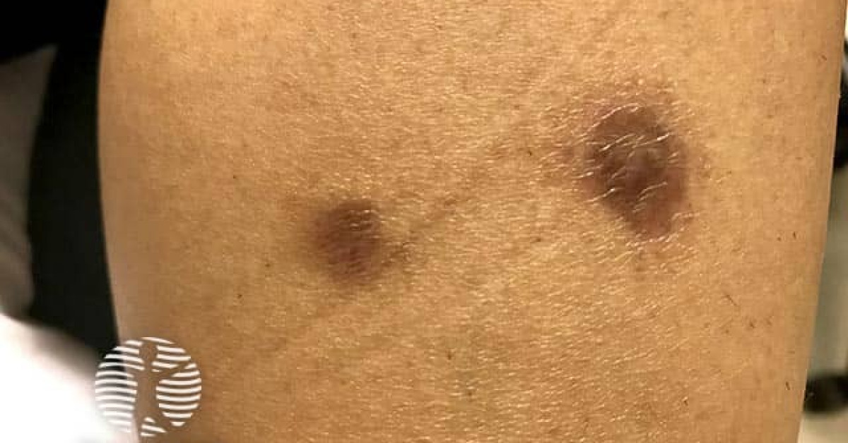 Annular Lichen Planus Lichen Planus: Symptoms, Types, And Treatment