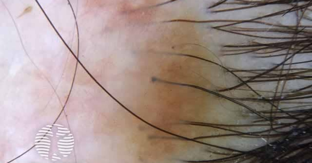 Aplasia cutis congenita image