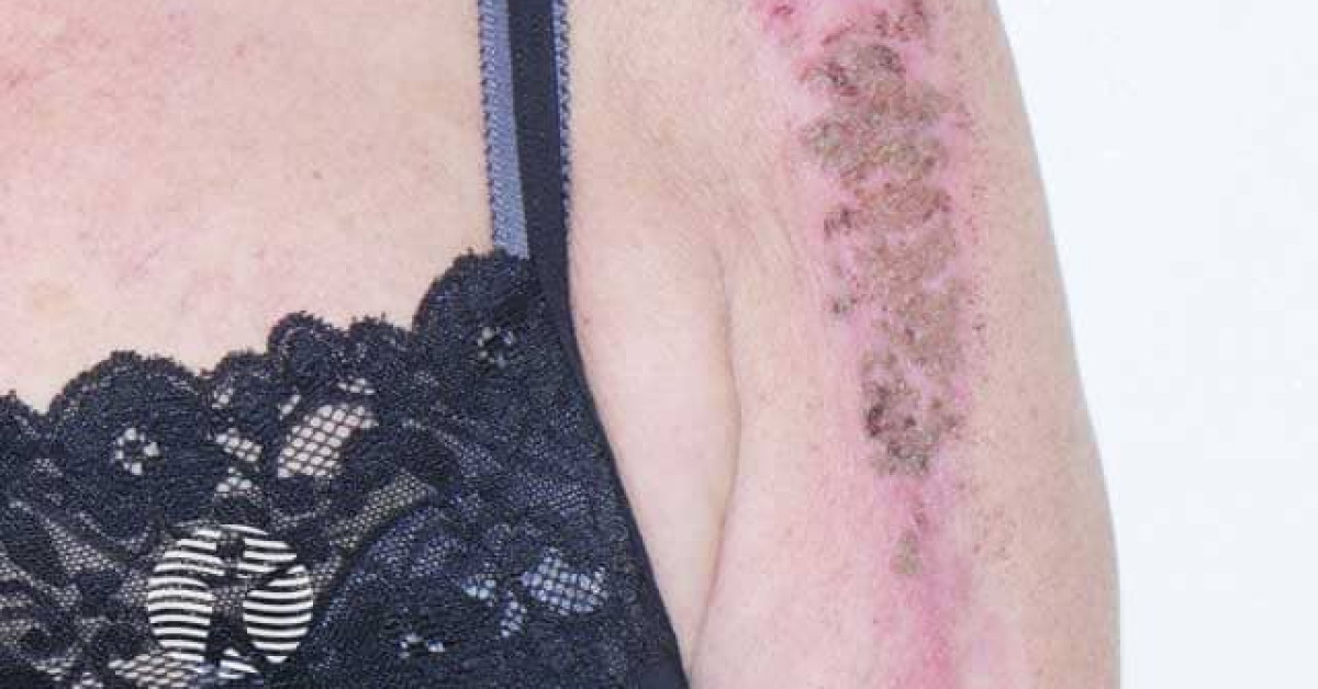 Aquagenic pruritus image