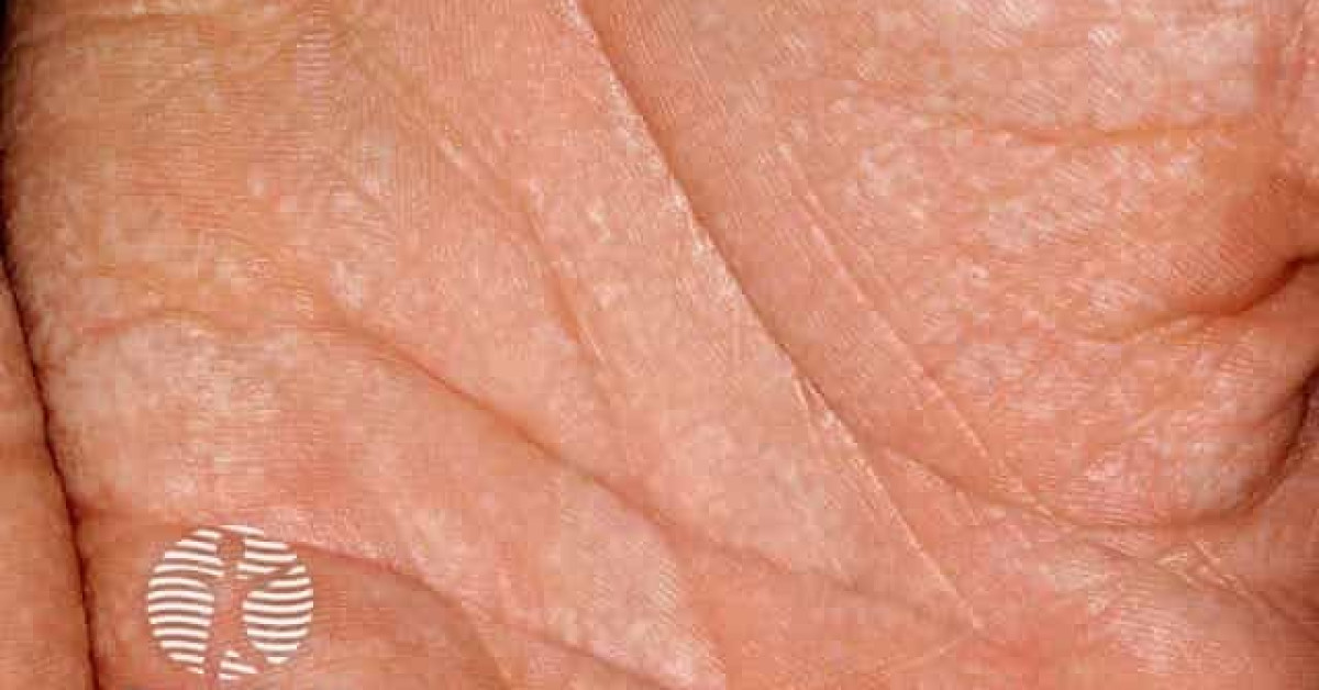 Aquagenic wrinkling of the palms image