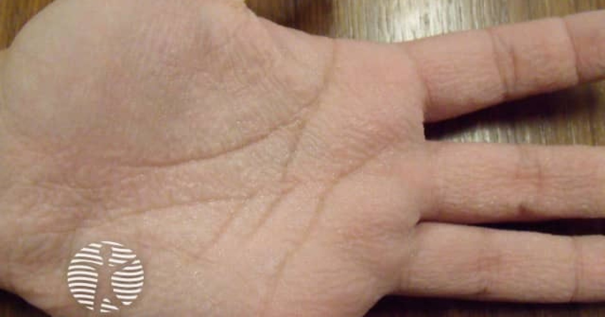 Aquagenic wrinkling of the palms image