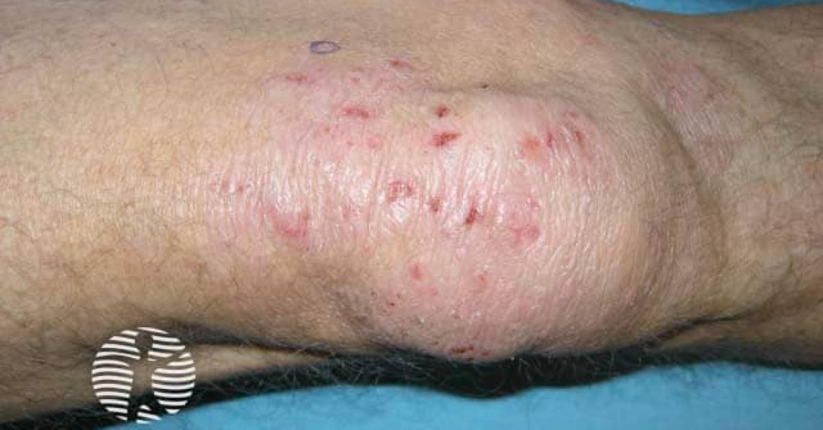 Atopic dermatitis image