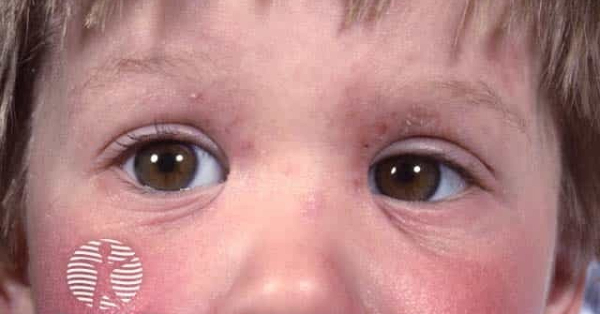 Atopic dermatitis image