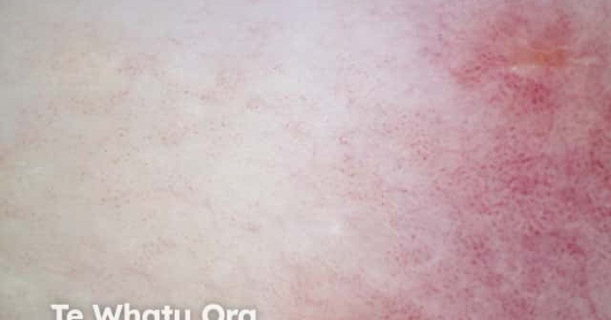 Atopic dermatitis image
