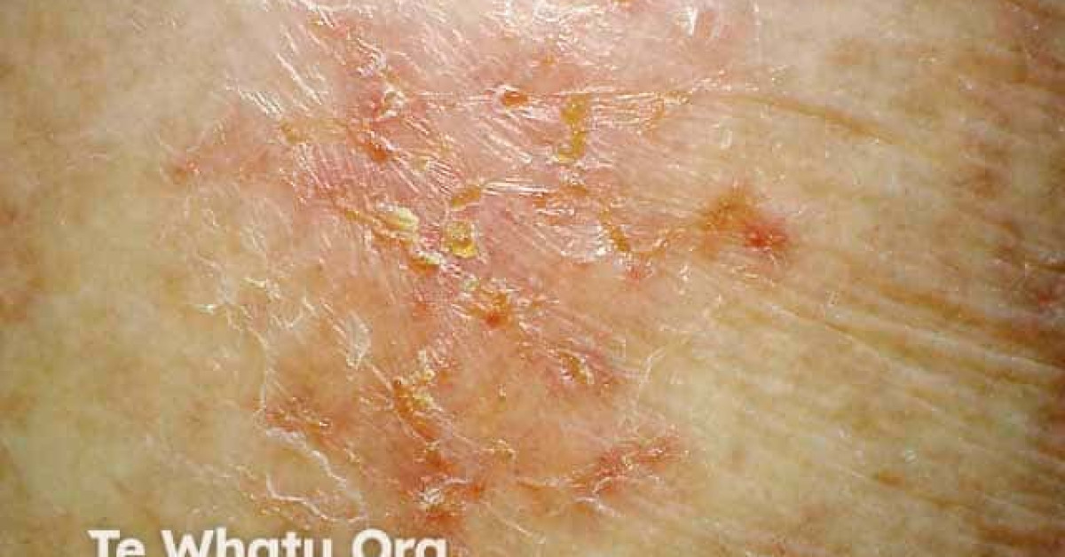 Atopic dermatitis image