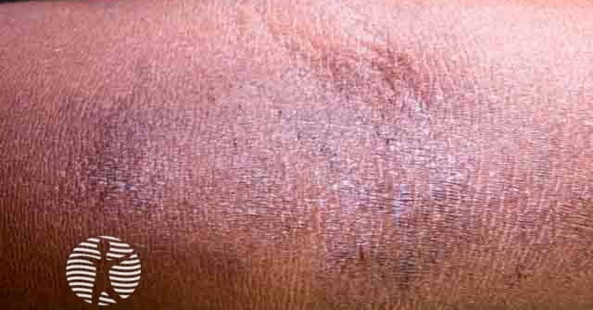 Atopic dermatitis image
