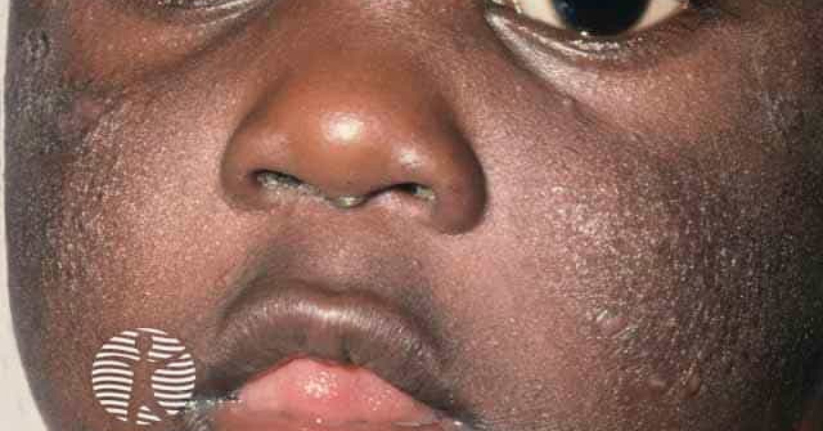 Atopic dermatitis image