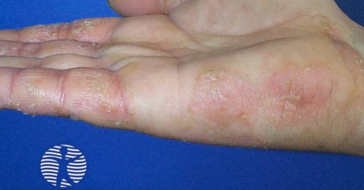 Atopic hand dermatitis image