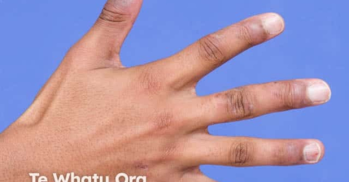 Atopic hand dermatitis image