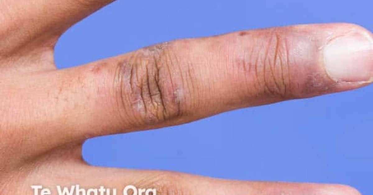 Atopic hand dermatitis image
