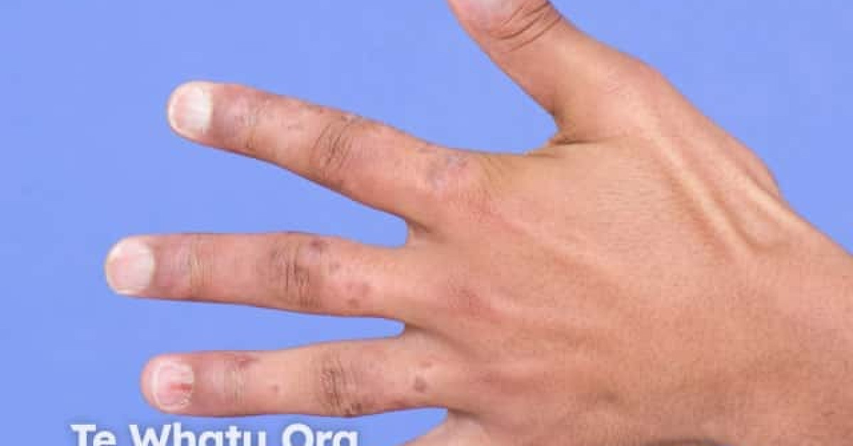 Atopic hand dermatitis image