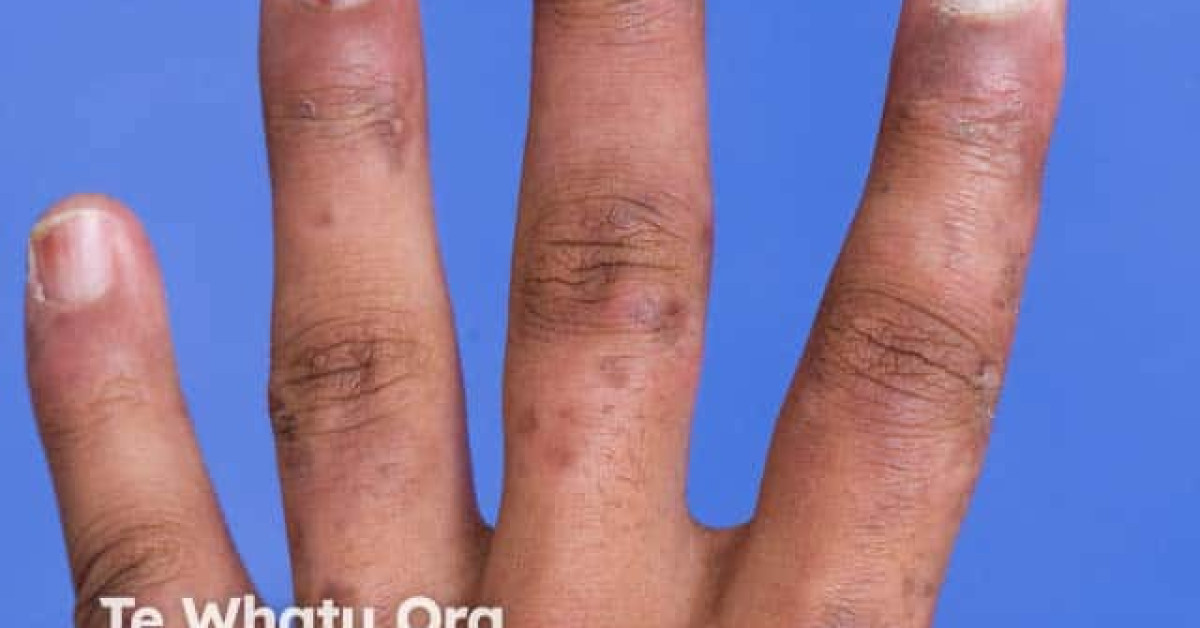 Atopic hand dermatitis image