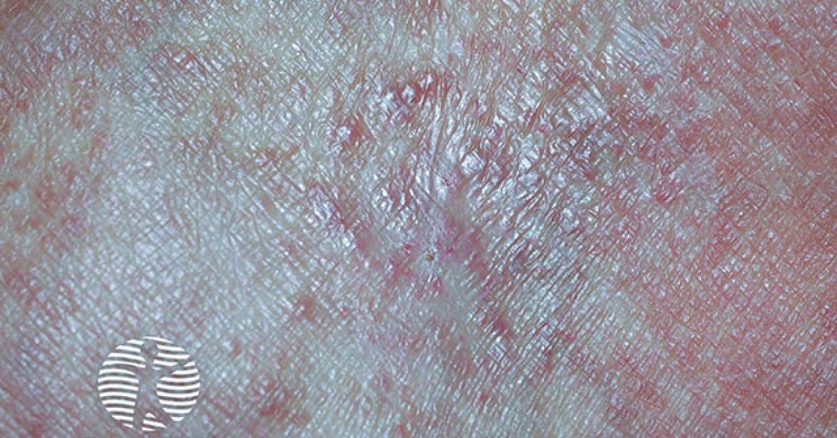 Atrophie blanche image