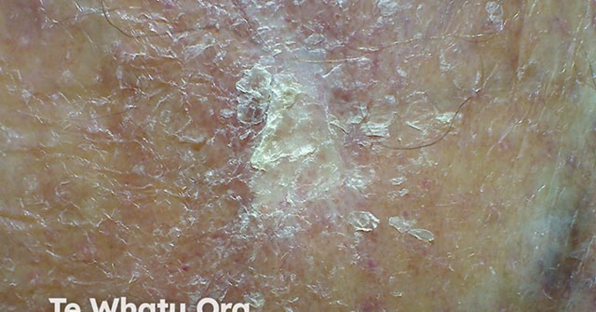 Atrophie blanche image