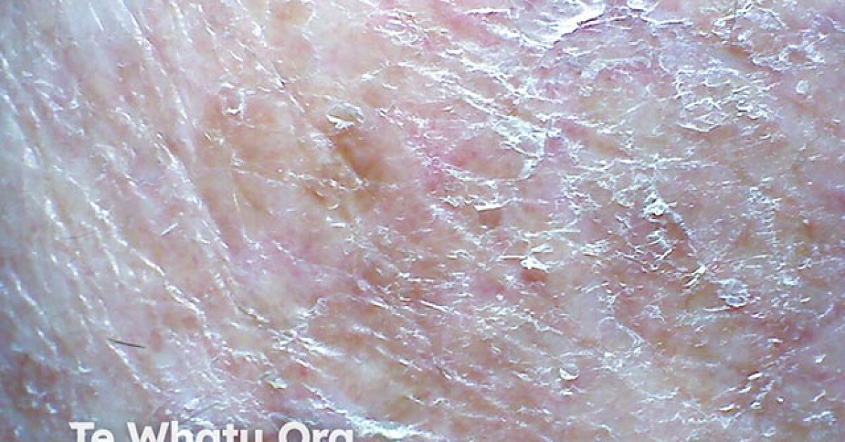 Atrophie blanche image