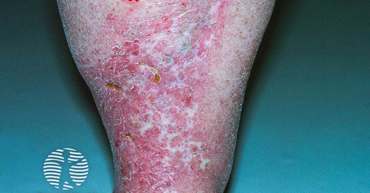 Atrophie blanche image