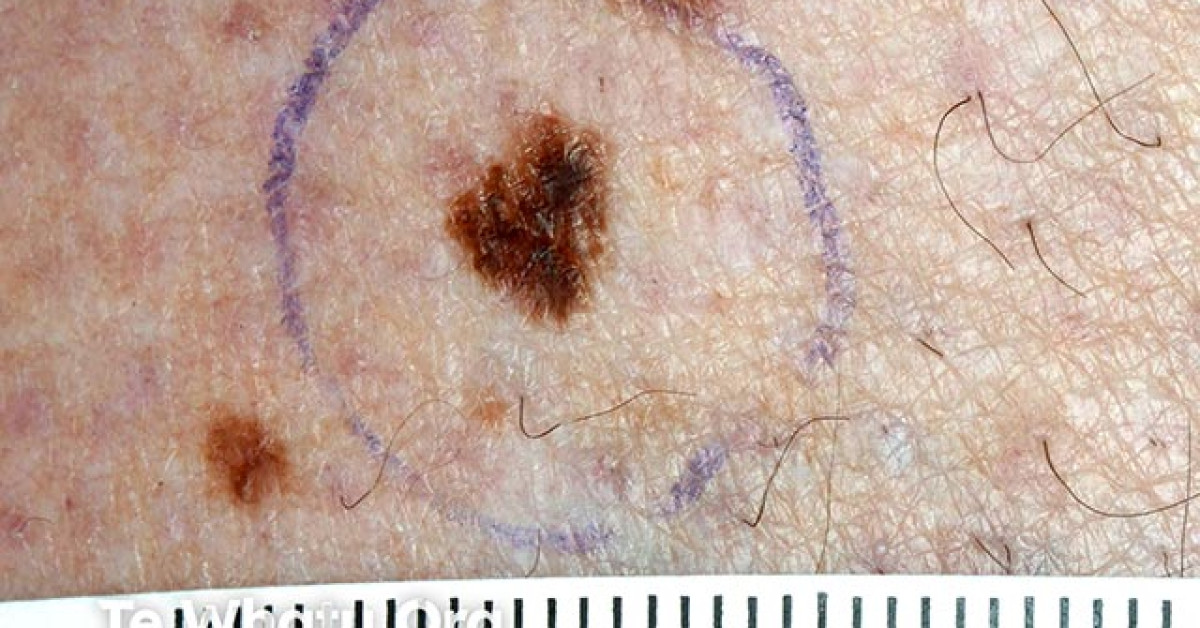 Atypical melanocytic naevus image