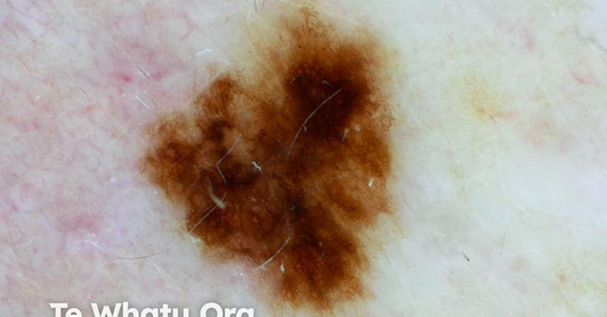 Atypical melanocytic naevus image