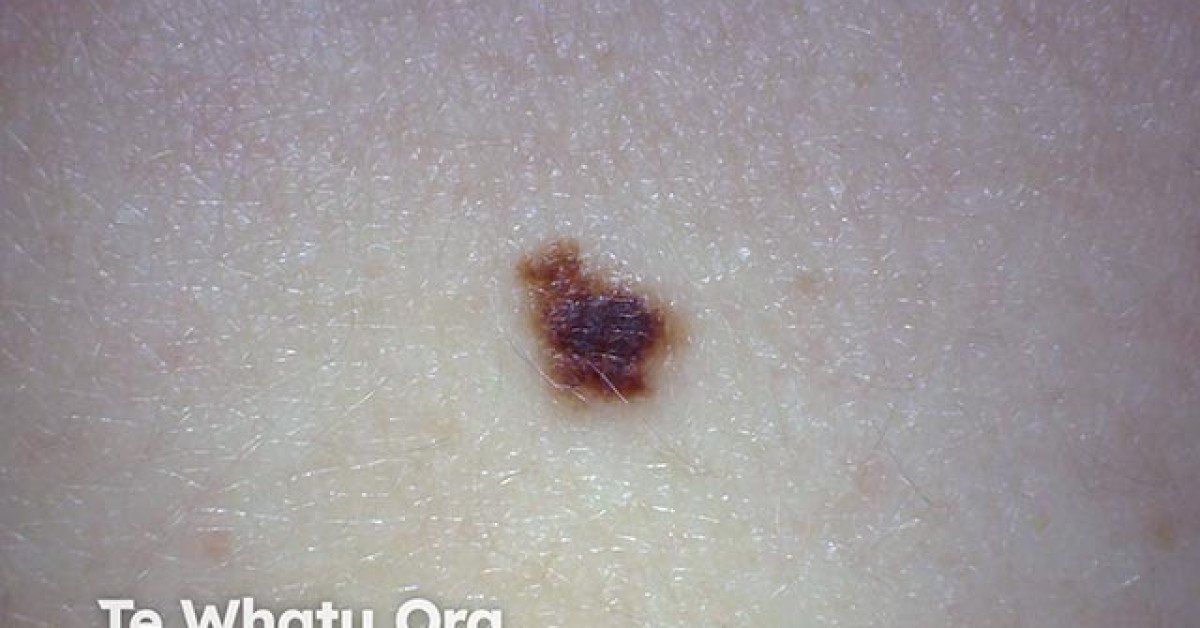 Atypical melanocytic naevus image
