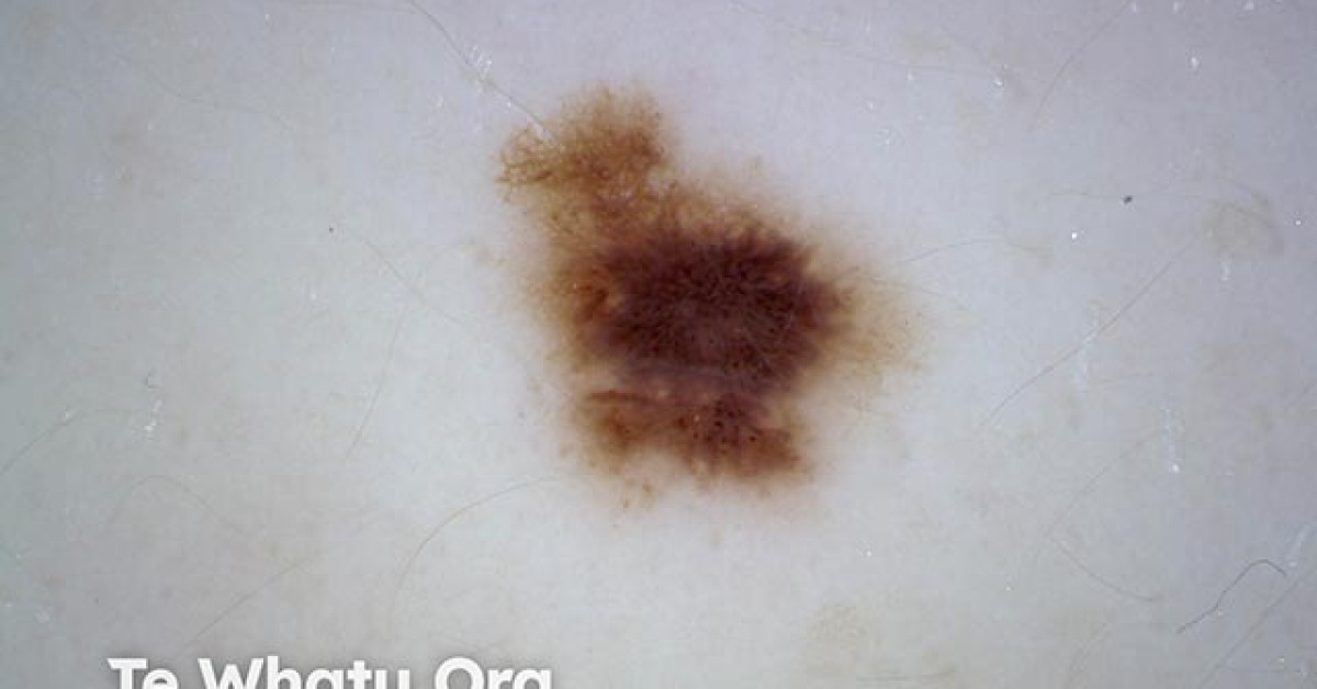 Atypical melanocytic naevus image