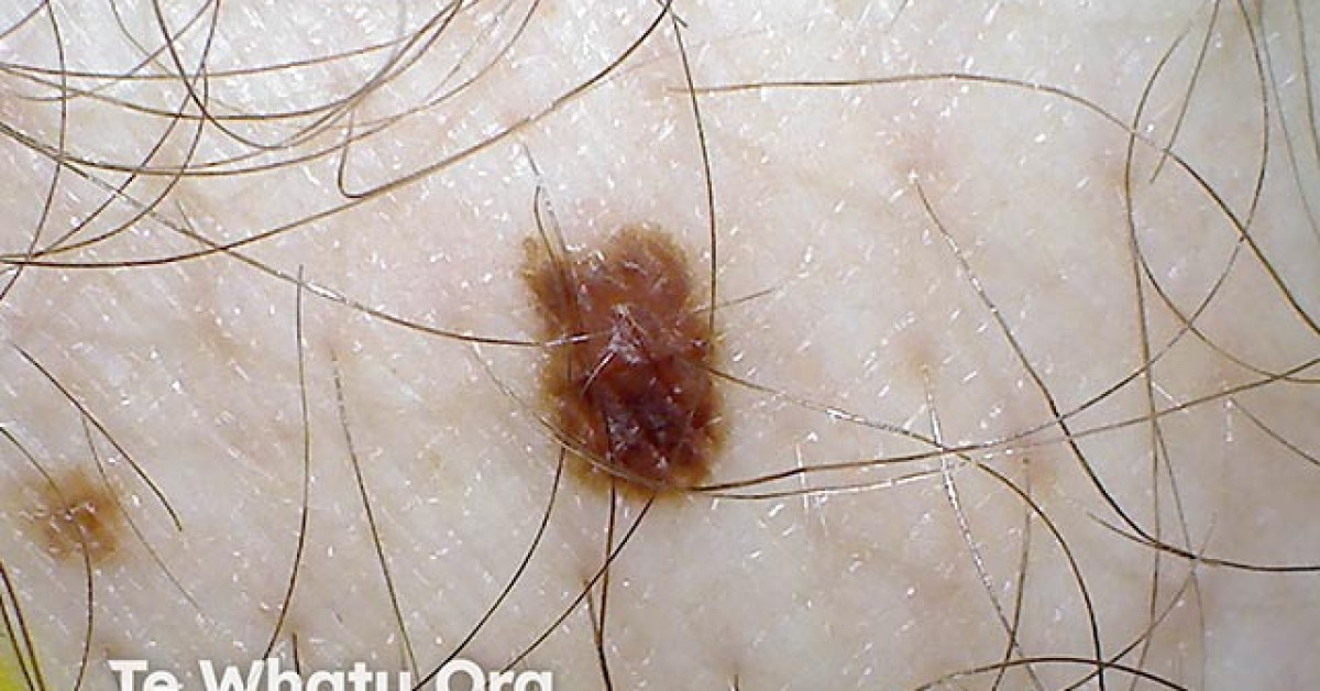 Atypical melanocytic naevus image