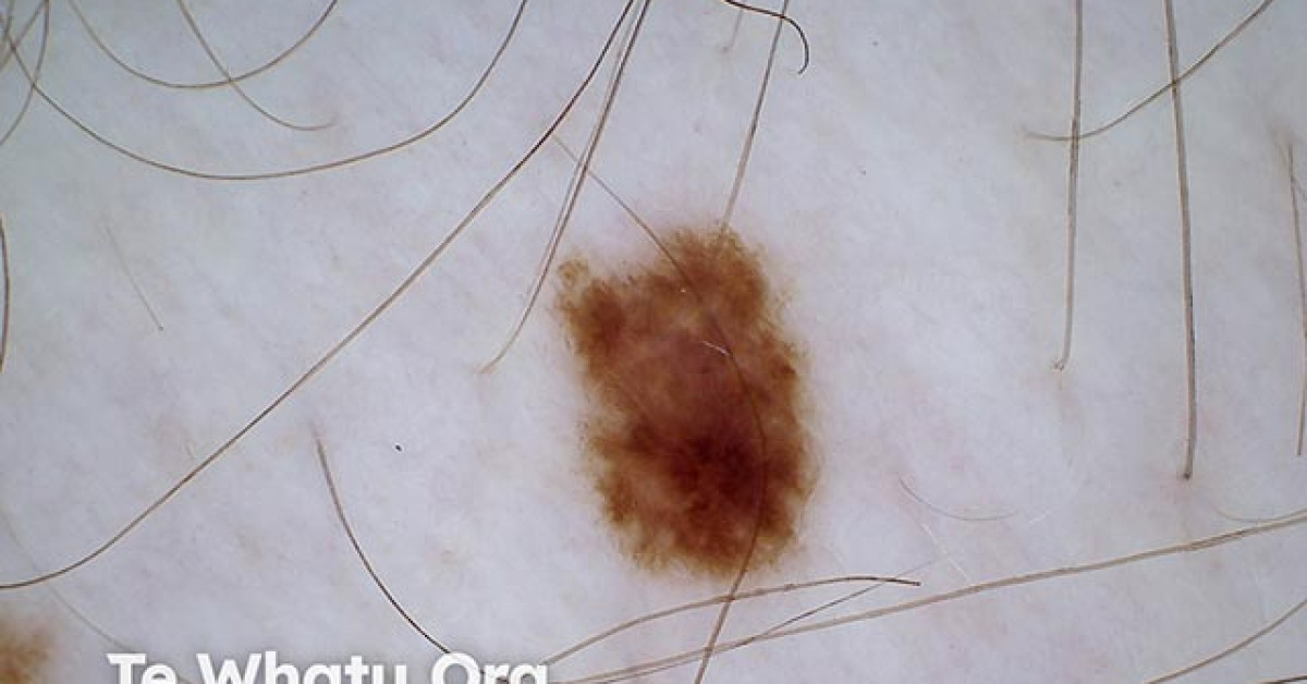 Atypical melanocytic naevus image