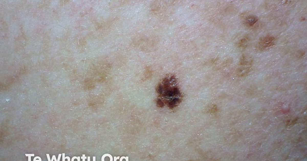 Atypical melanocytic naevus image