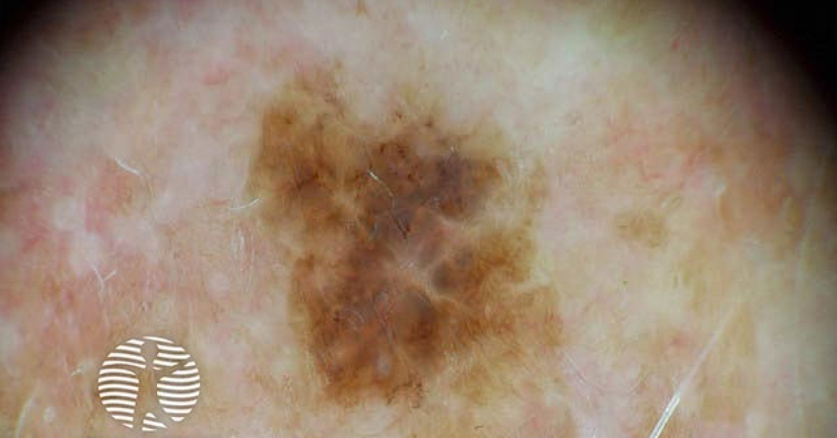 Atypical melanocytic naevus image